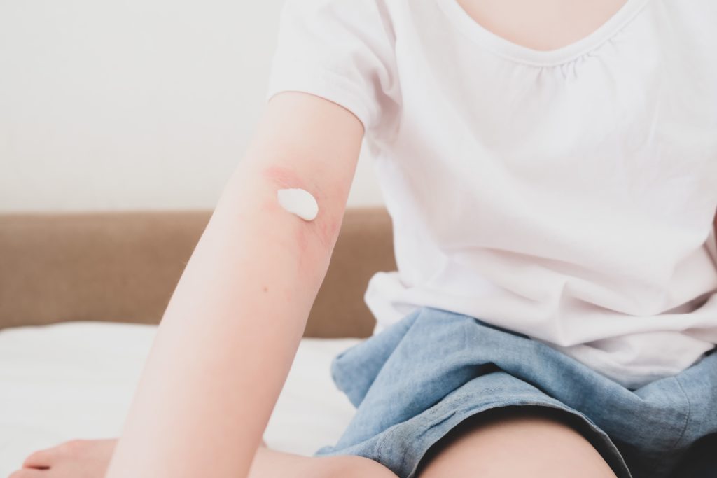 Available Atopic Dermatitis Therapies for Pediatric Patients ...